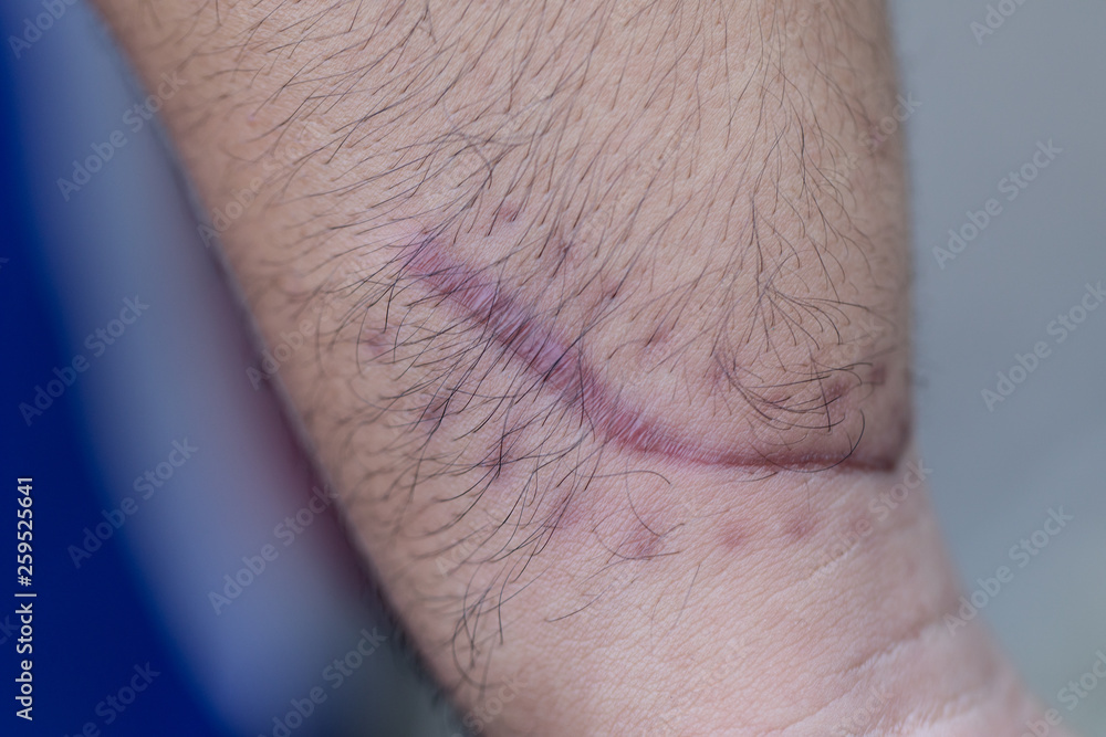 A scar is an area of fibrous tissue that replaces normal skin after an ...