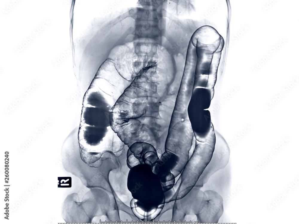 barium enema image or x-ray image of large intestine AP view showing ...