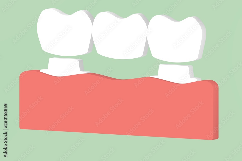 dental crown with bridge, installation process and change of teeth ...