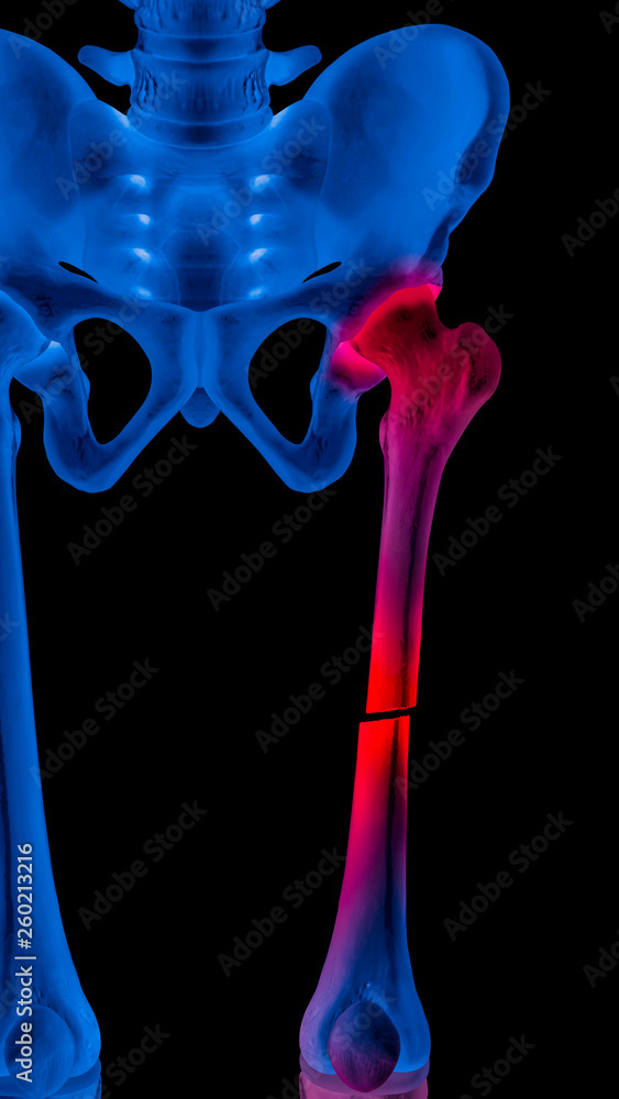 X-ray of broken upper leg or femur fracture anterior view completed ...