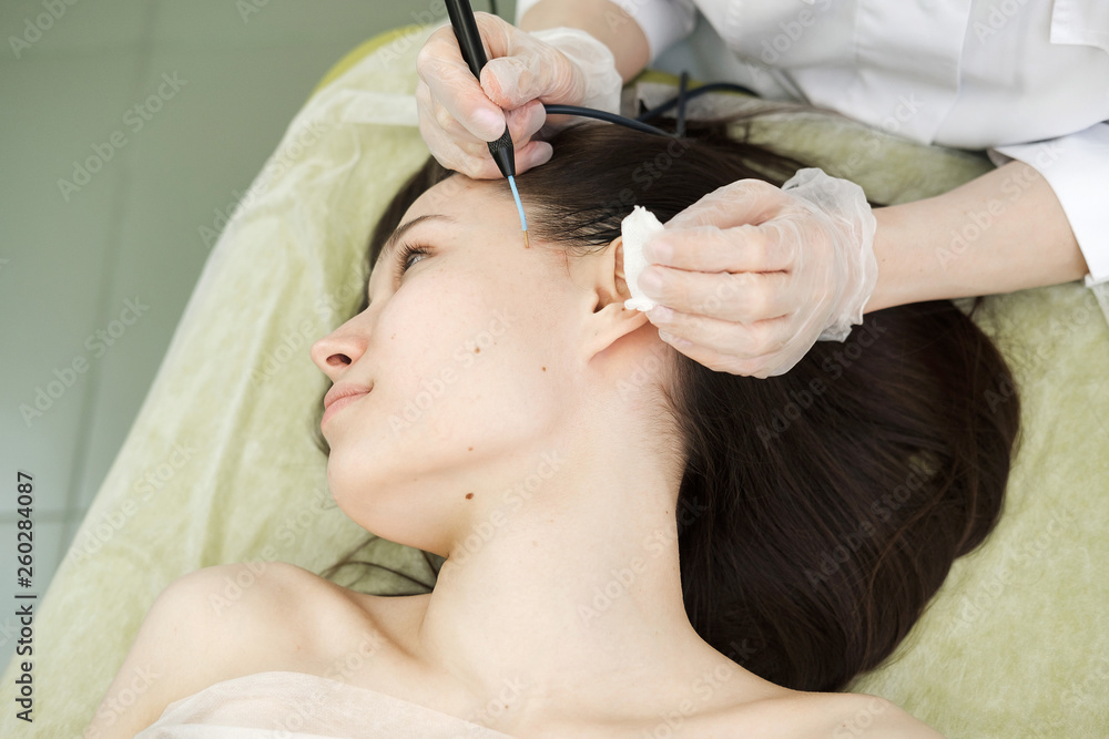 Medical Treatment Removal Of Birthmark From Female Patients Face