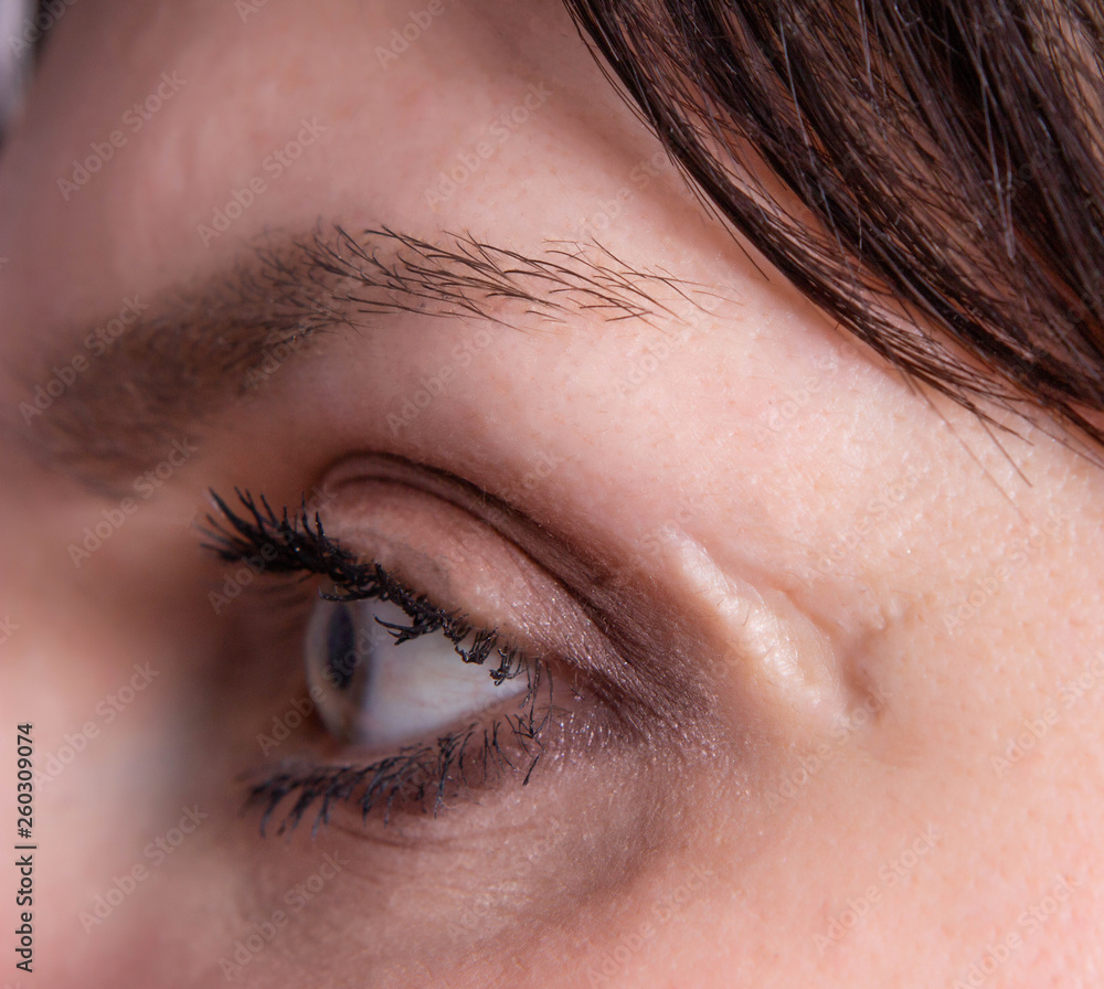 deep scar and scar on the face of the girl near the eye, close-up, skin ...