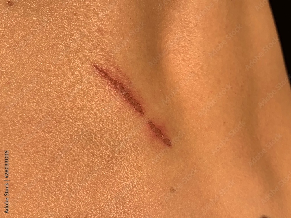 Scratch on the woman's back. Human skin texture. An abrasion on a man's back. Scratched skin on ...