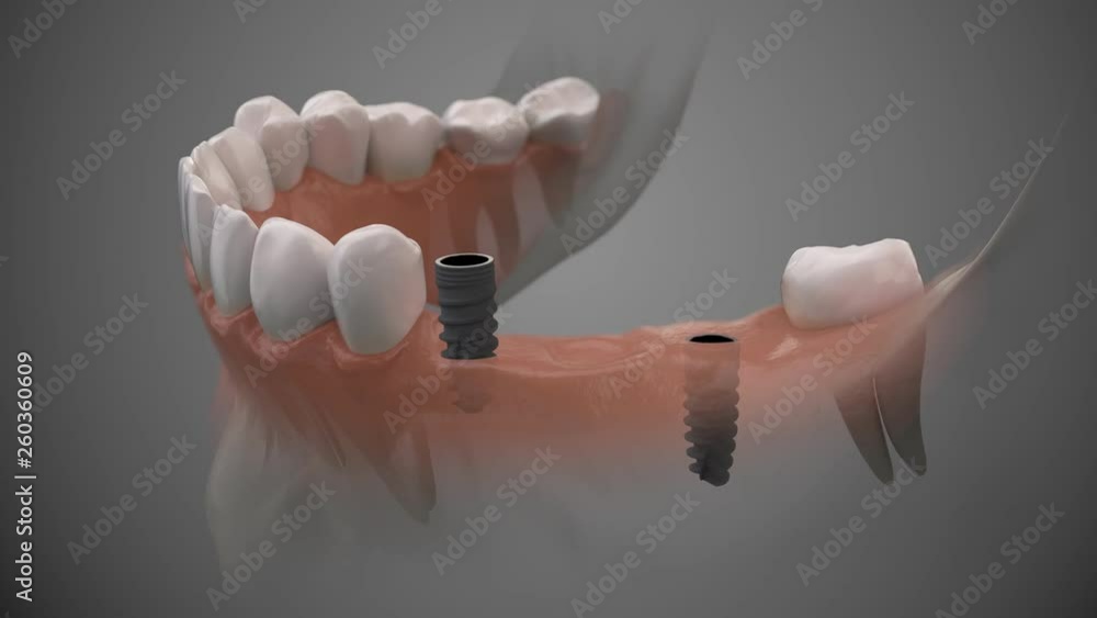 Tooth bridge human implant. Dental prosthetic innovation. 3d animation ...