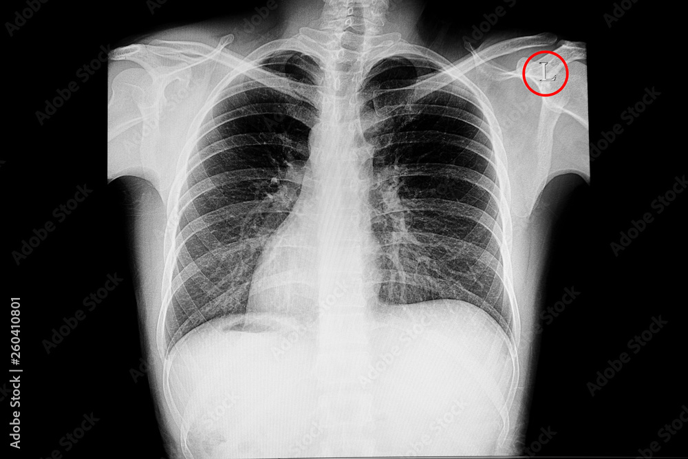 chest xray of the patient with situs inversus Stock Photo | Adobe Stock