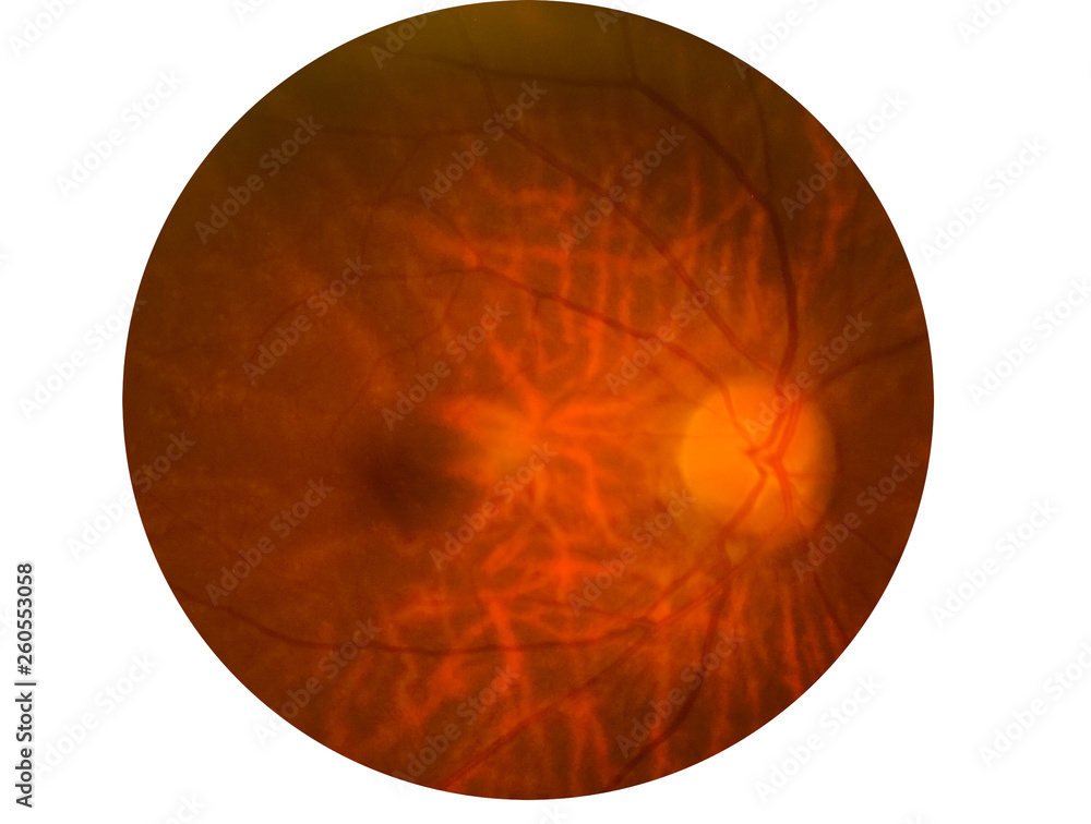 Retina of diabetes , diabates retinopathy,photo Medical Retina Abnormal ...