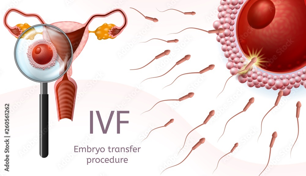 In Vitro Fertilization. Embryo Transfer Procedure Stock Vector | Adobe ...