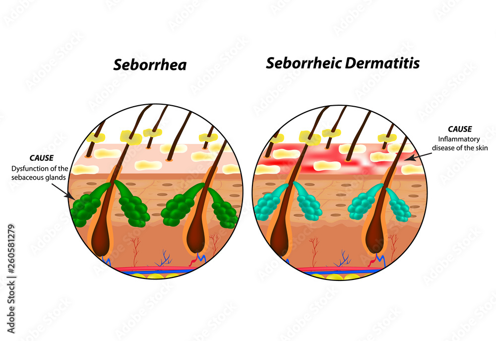 Causes Seborrhea skin and hair. Dandruff seborrheic dermatitis. Eczema ...