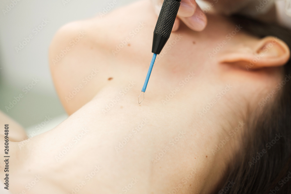 Medical Treatment Removal Of Birthmark From Female Patients Neck