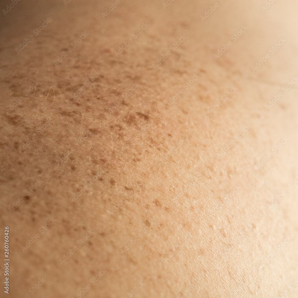 Close up detail of the bare skin on a man back with scattered moles and ...