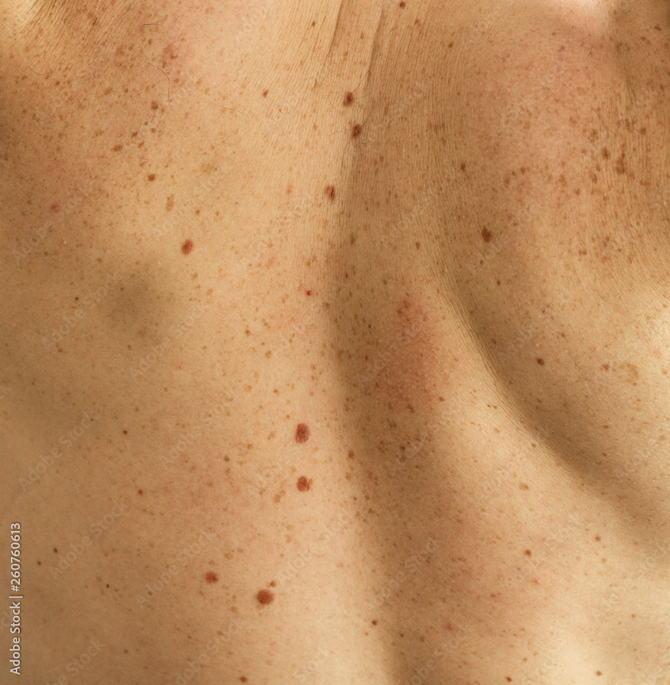 Close up detail of the bare skin on a man back with scattered moles and ...