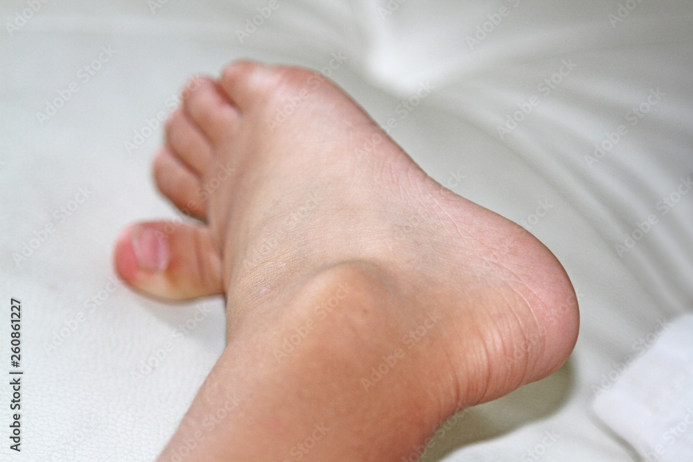 Bare foot with bending toes Stock Photo | Adobe Stock