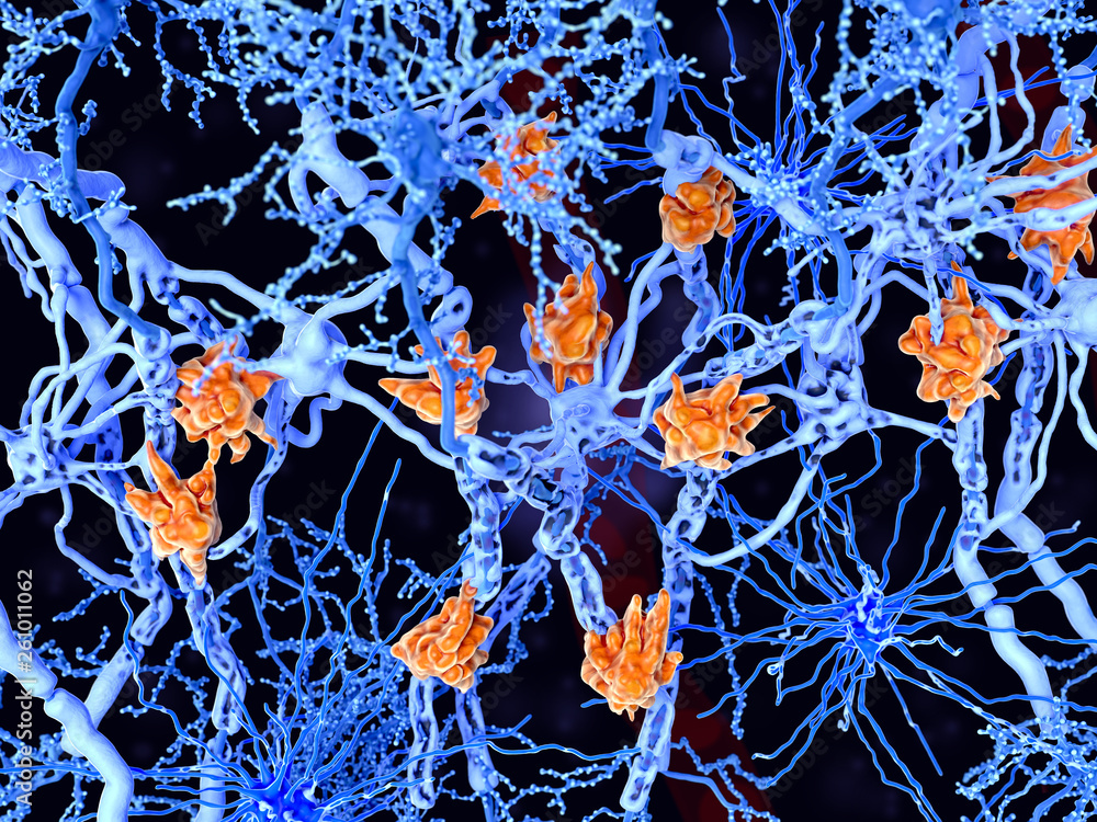 Multiple sclerosis (MS): microglia cells damage the myelin sheath of ...
