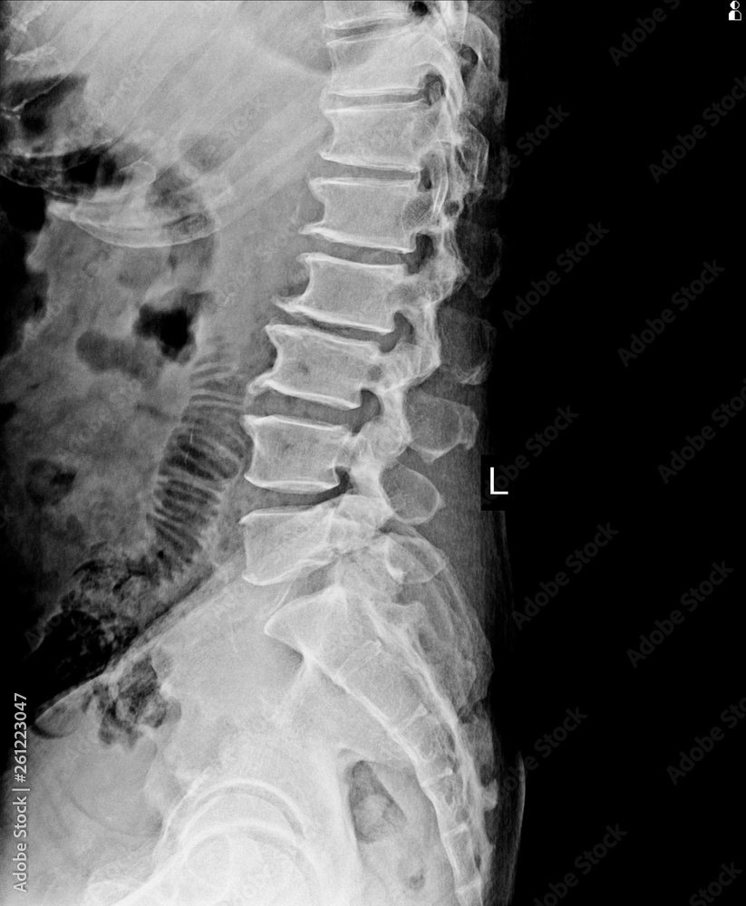 Lumbar spine x-ray show spur of vertebral body. Stock Photo | Adobe Stock