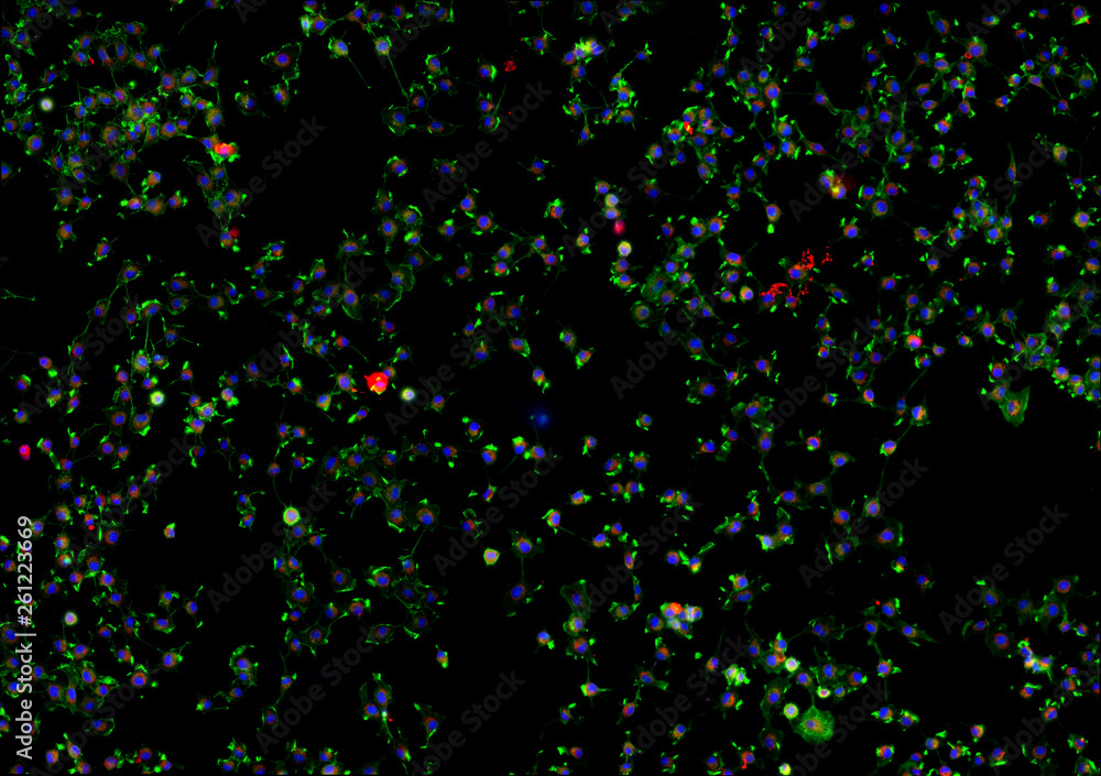 Real fluorescence microscopic view of cancer cells - human melanoma ...
