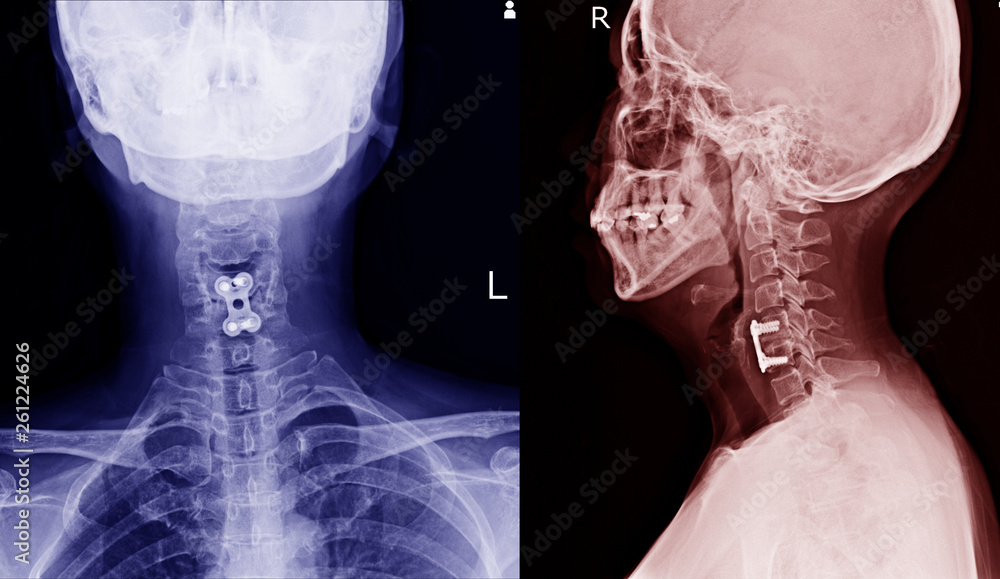 X-ray C-SPINES show post operation internal fixation C4-C5 & C6 with ...