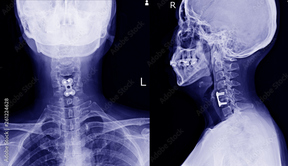 X-ray C-SPINES show post operation internal fixation C4-C5 & C6 with ...
