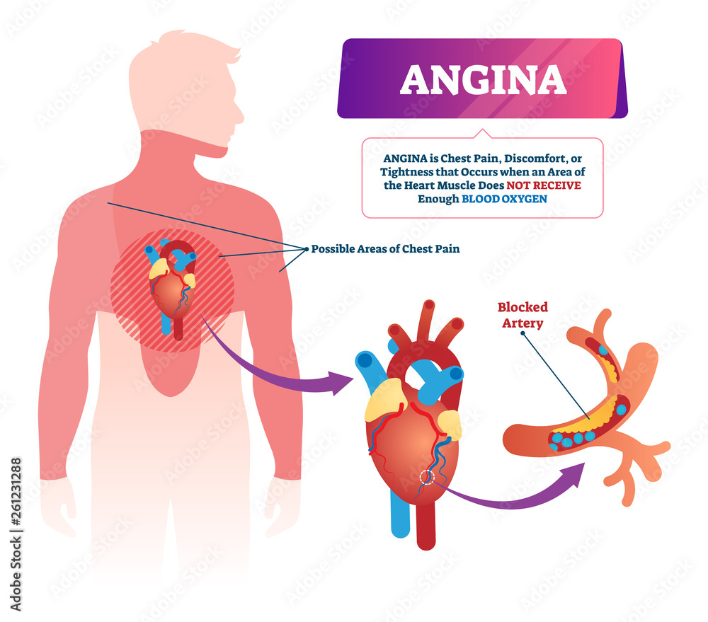 Angina vector illustration. Labeled medical chest pain and heart ...