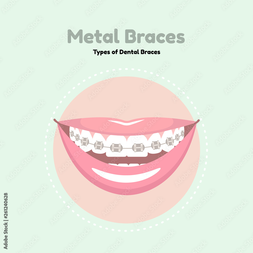 Metal Dental Braces. Types of Dental Braces. Vector flat illustration ...