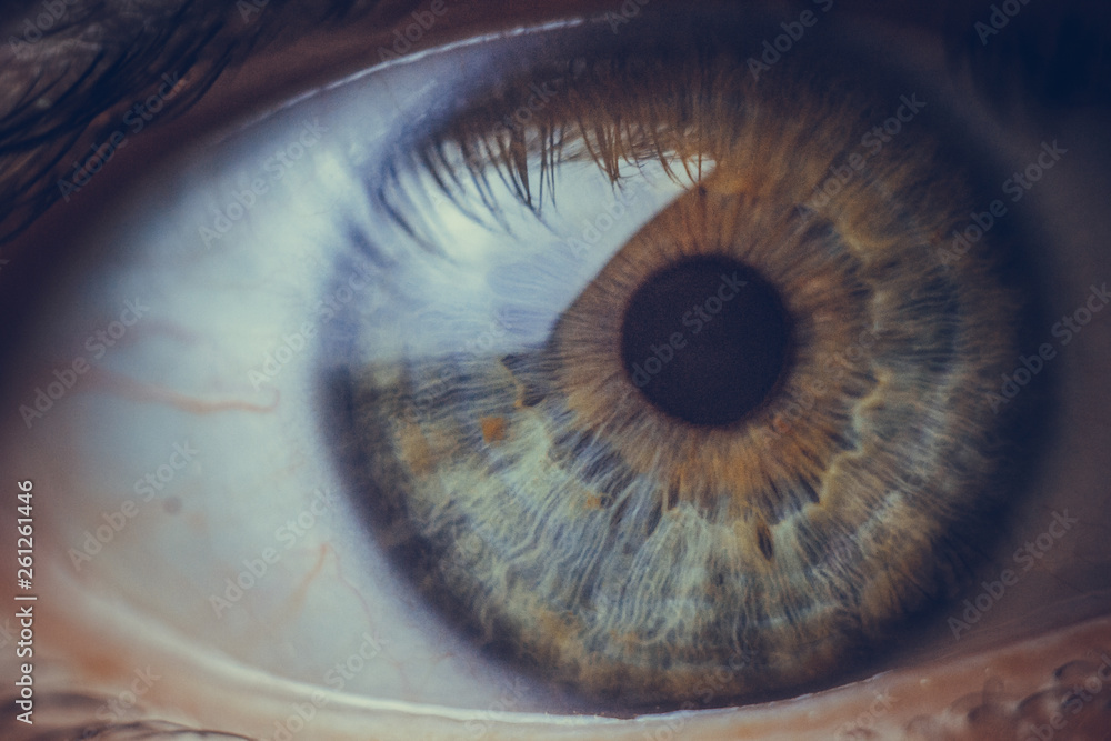 macro eyes with bursting red blood vessels. eyeball covered with blood ...