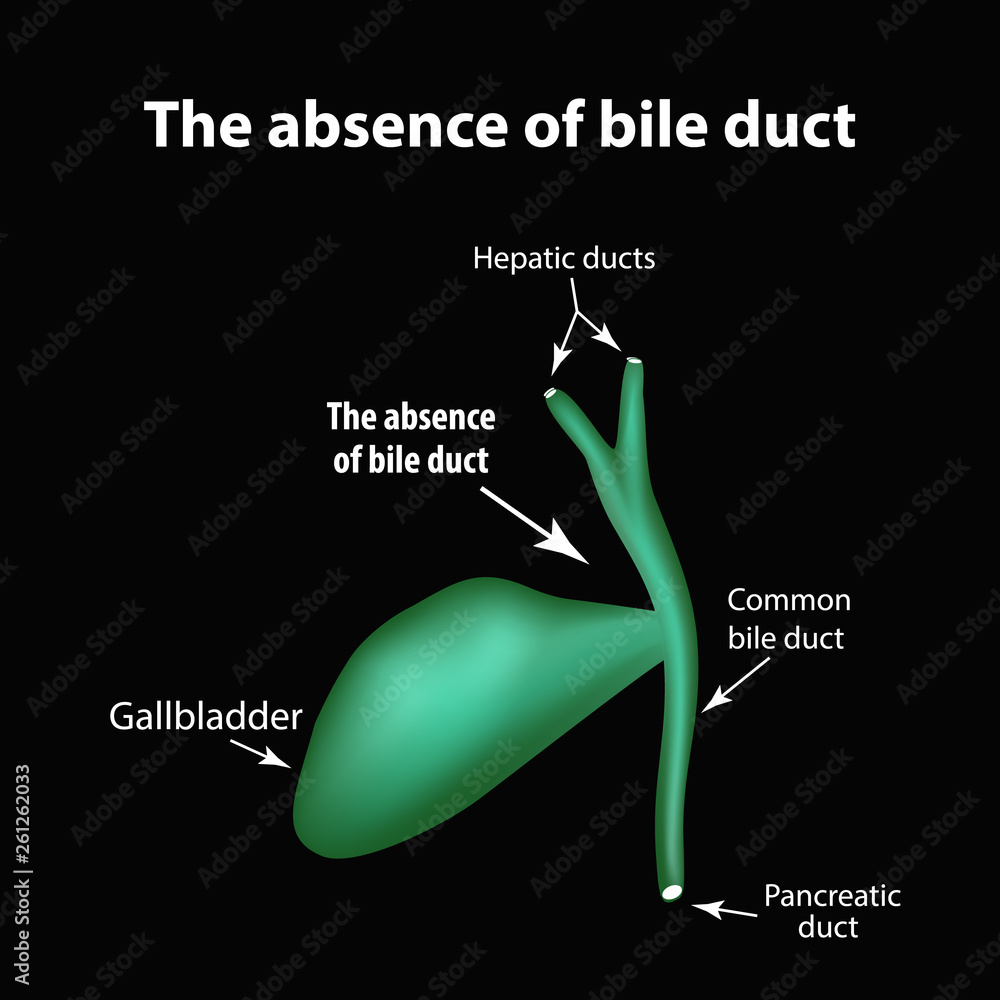 The absence of bile duct. Pathology of the gallbladder. Cholecystitis ...