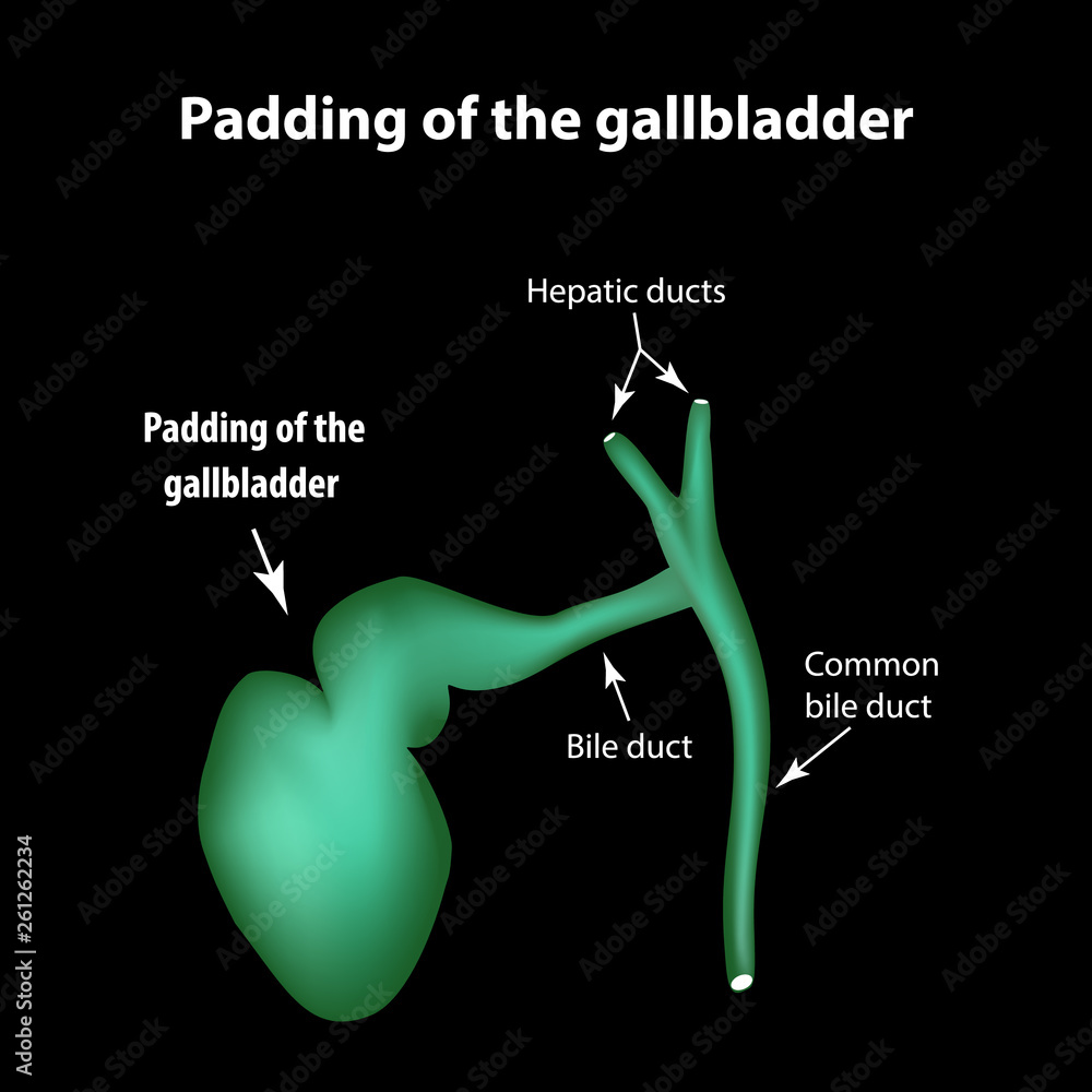 Padding of the gallbladder. Pathology of the gallbladder. Cholecystitis ...