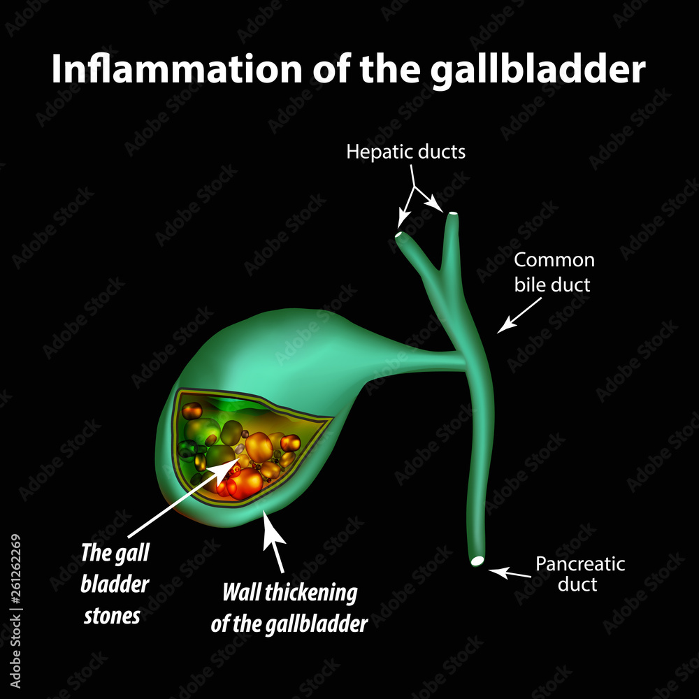 Gallstones. Cholelithiasis. Cholecystitis. Inflammation of the ...