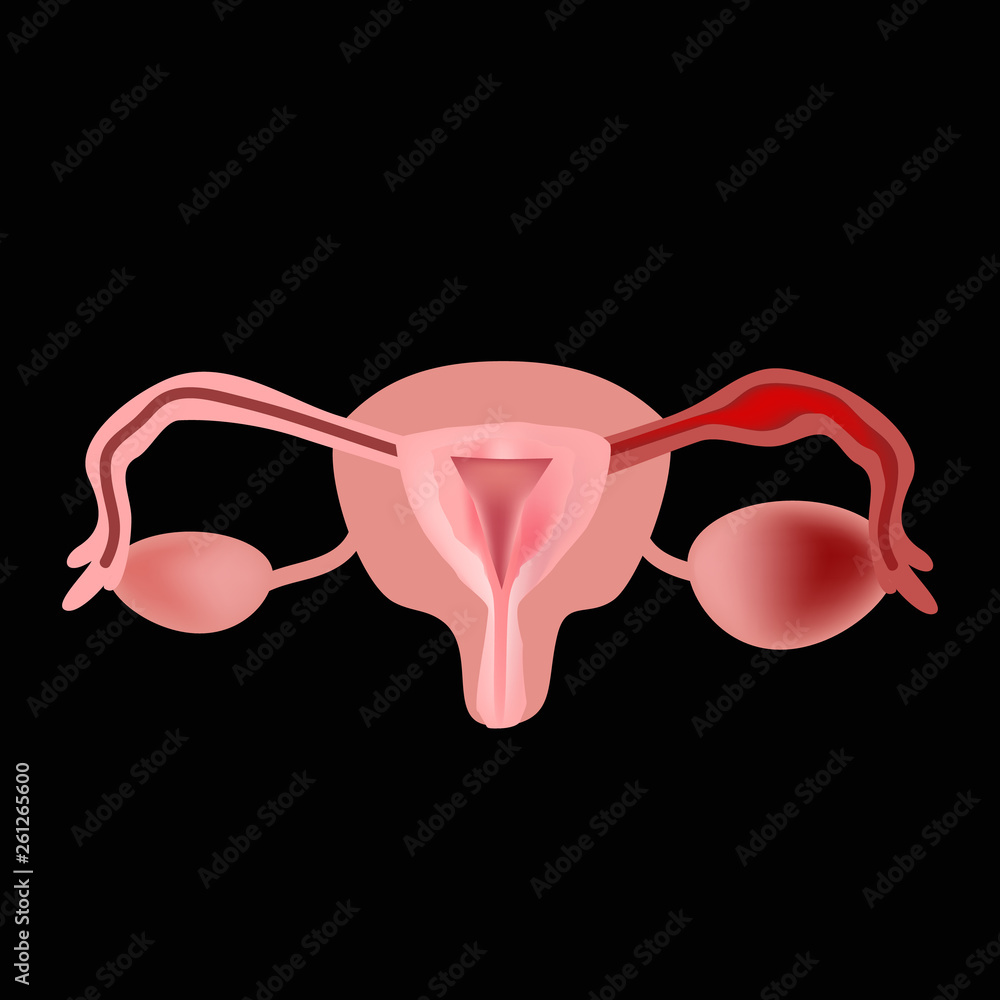 Salpingitis. Inflammation of the fallopian tube. Oophoritis. the ovary ...