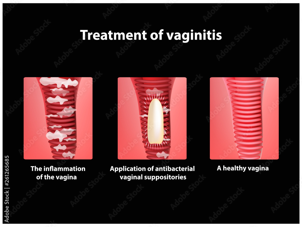 Vaginitis And Vulvovaginitis