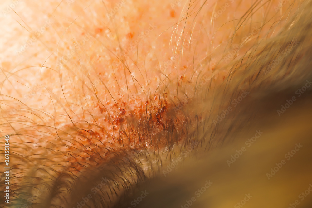 Head wound after a car accident. Dried blood on forehead. Traces of ...