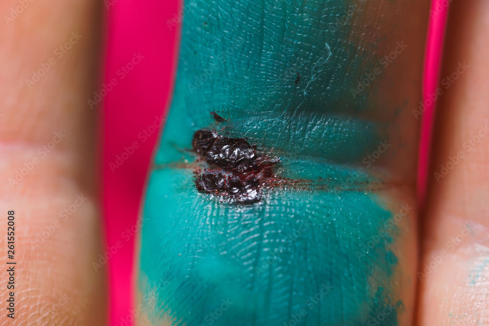Wound to the finger. A solution of green diamond on the finger. Damage ...