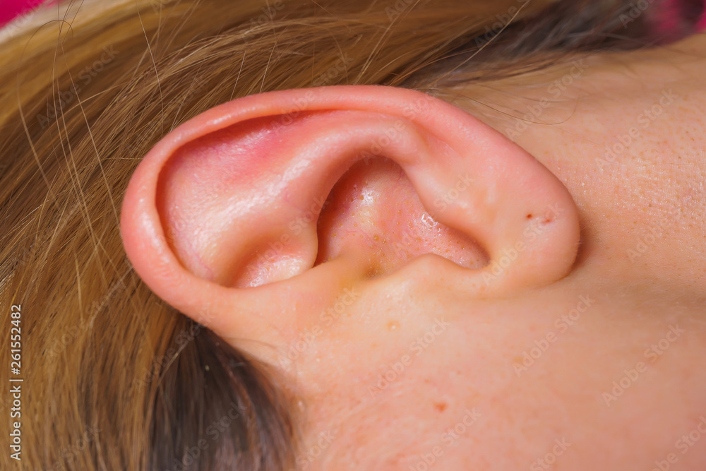 Female ears closeup. Inflamed skin of the ears. Auricle girls with acne ...