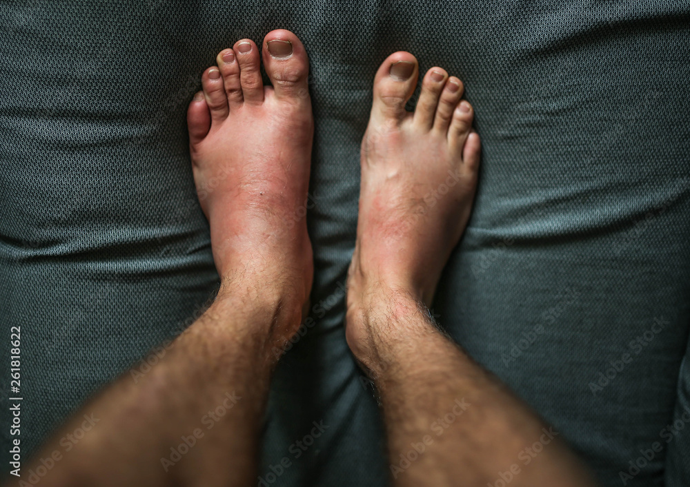 allergic reaction to the legs, swollen toes. angioedema Stock Photo ...