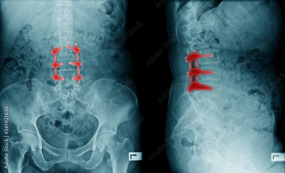 lumbar compression fracture with internal fixation Stock Photo | Adobe ...
