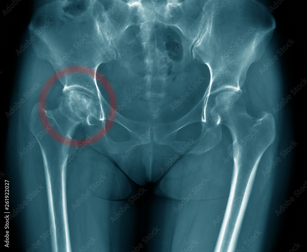 x-ray image of old woman show degenerative change of hip joint, hip ...