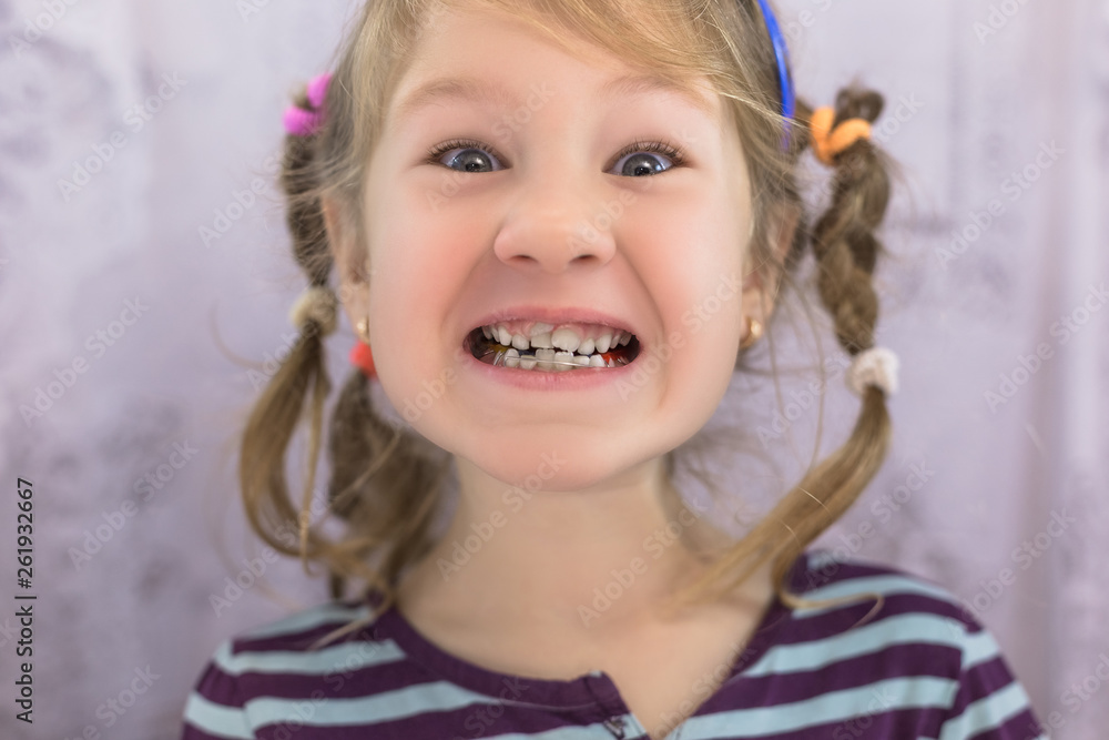 Adult permanent teeth coming in front of the child's baby teeth: shark ...