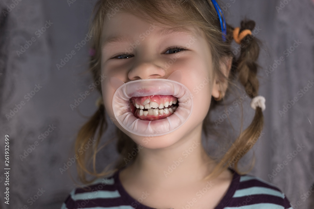 Adult permanent teeth coming in front of the child's baby teeth: shark ...
