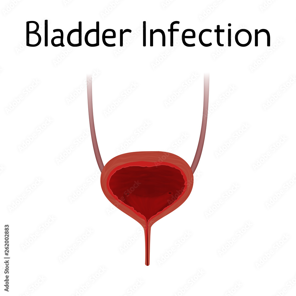 Anatomy picture of bladder infection, pain. Realistic medical ...