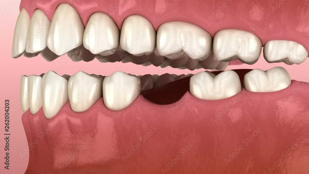 Video „Teeth shift deformatiuon after losing molar tooth. 3D animation ...