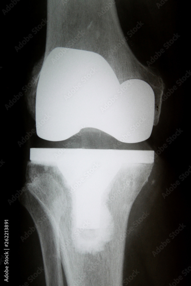 X-Ray image of knee with complete artificial joint replacement ...