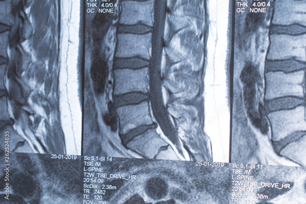 Magnetic Resonance Tomography Mrt Of The Lumbar Spine Hernia Of The
