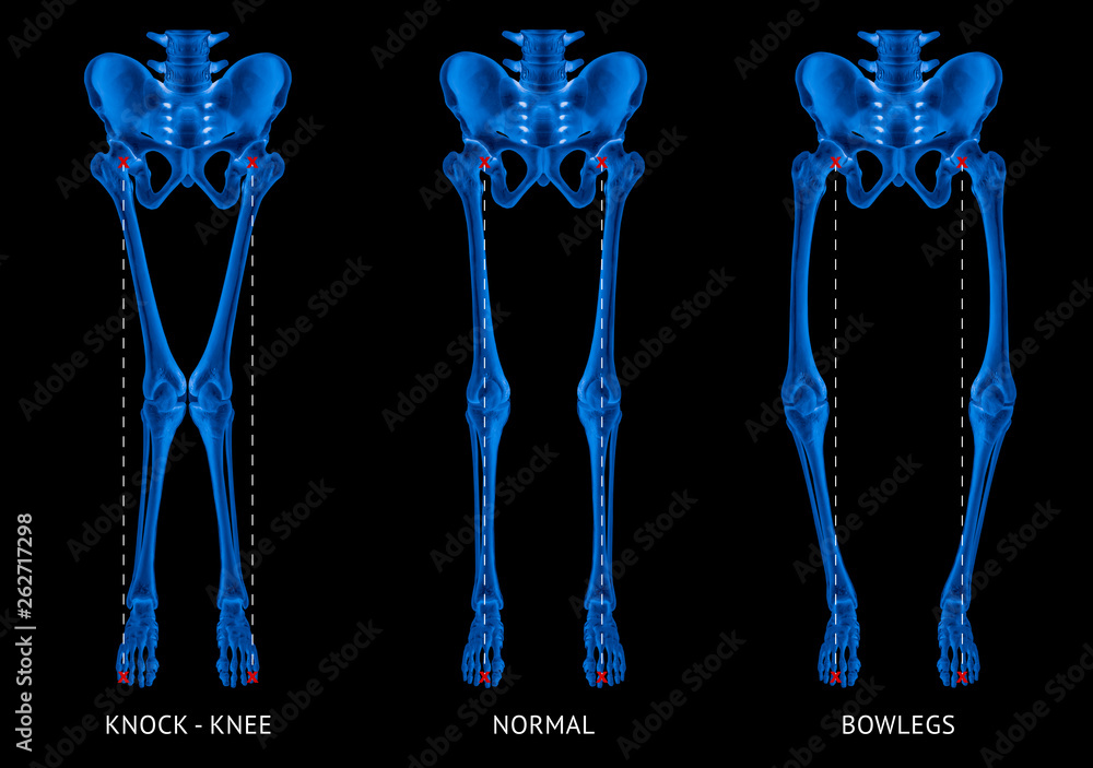 Alignment types disease leg bone problem of knock knee -Normal and ...