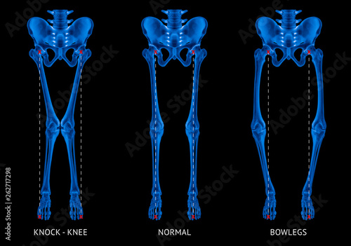 Alignment types disease leg bone problem of knock knee -Normal and ...