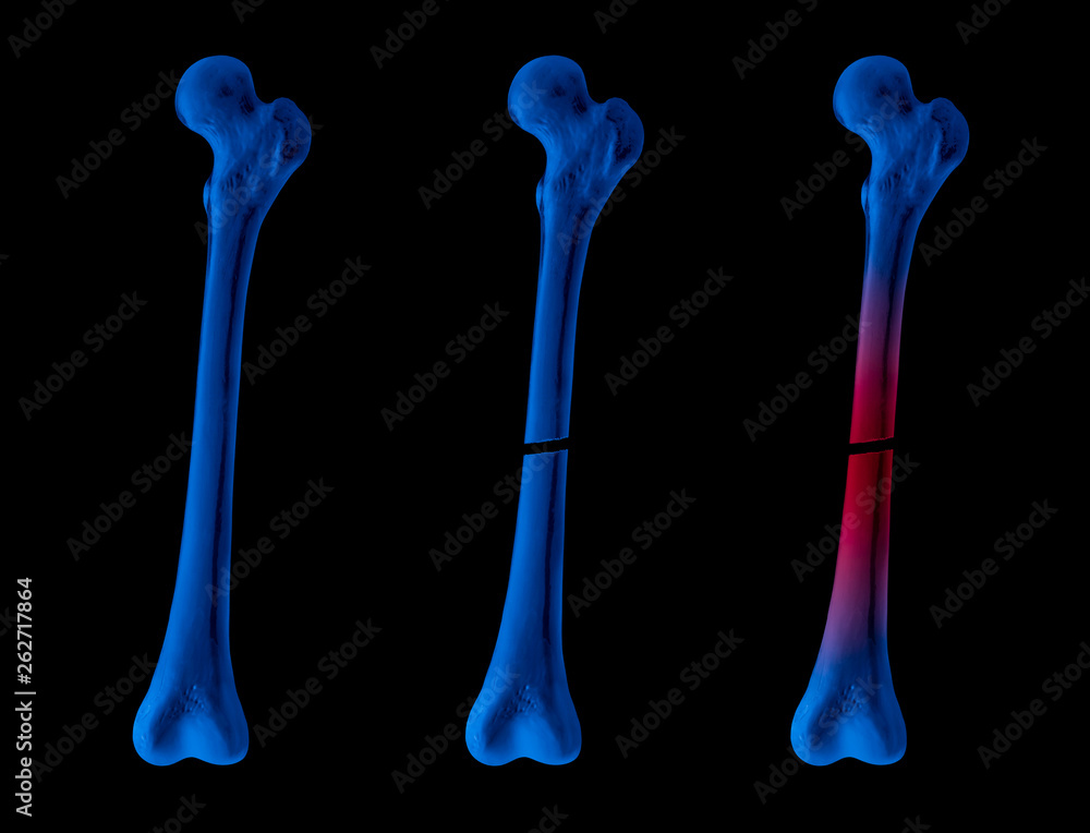 Collection of Broken bone or Bone Fractures completed displaced ...