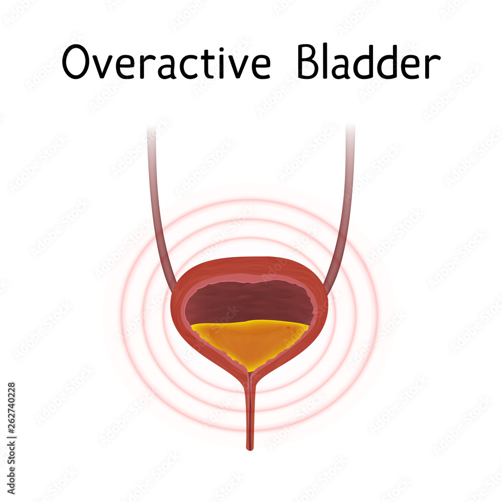 Anatomy picture of Overactive bladder. Realistic medical illustration ...