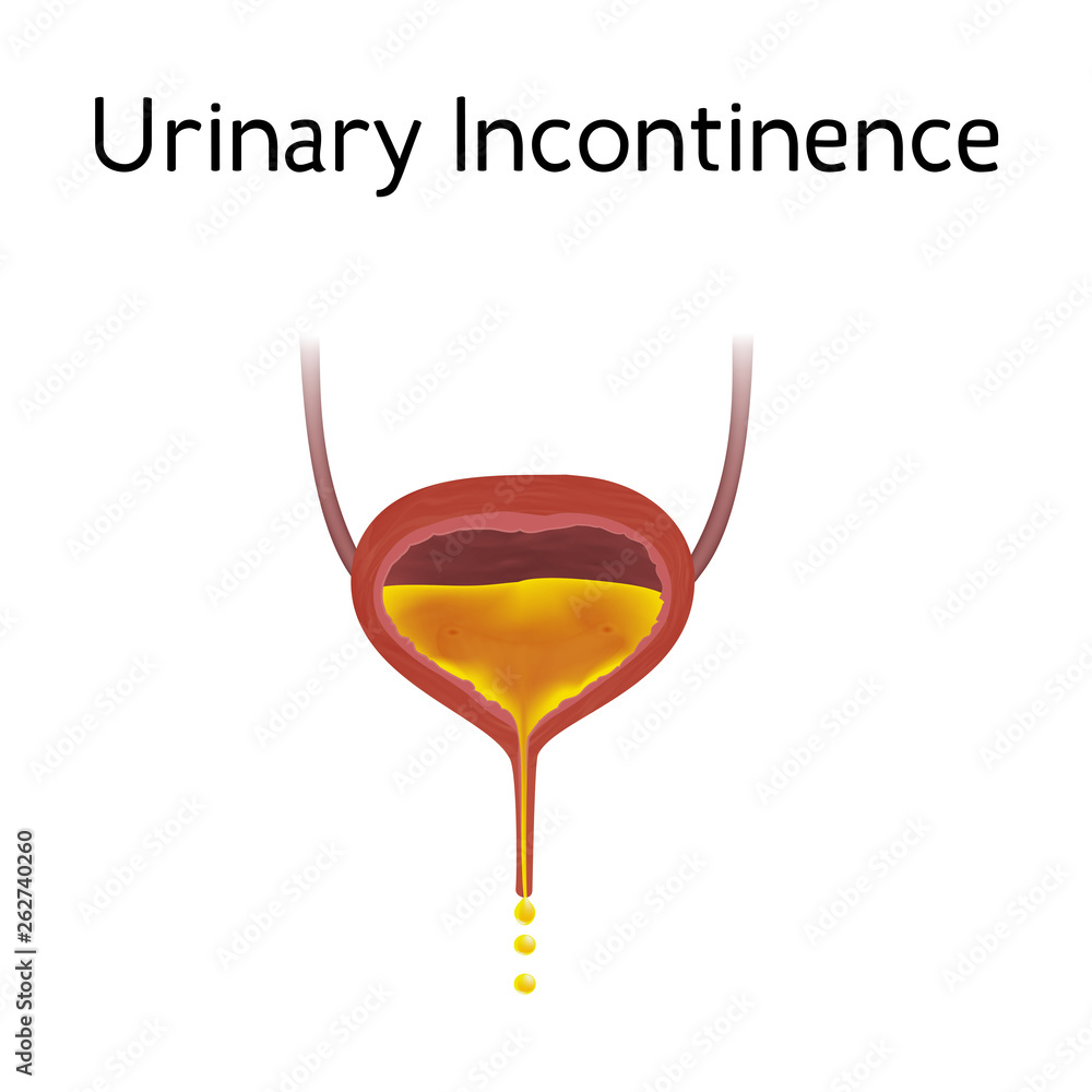 Anatomy picture of Urinary incontinence. Realistic medical illustration ...