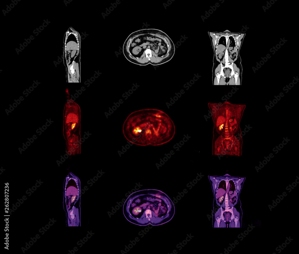 PET Scan image of whole body Comparison Sagittal, Axial and Coronal ...