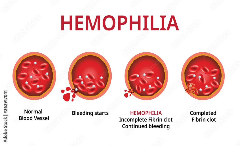 Hemophilia. damaged blood vessel, Haemophilia (Coagulation disorder) - Vector Stock Vector ...