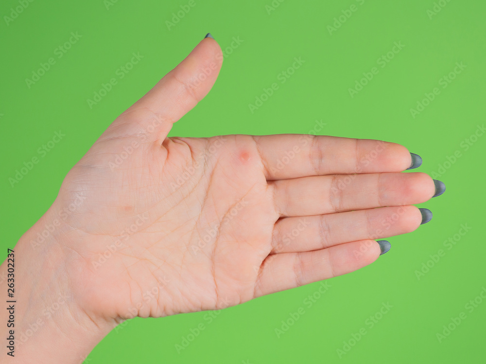 One small red callus on skin of hand of palm of white woman. Horizontal ...