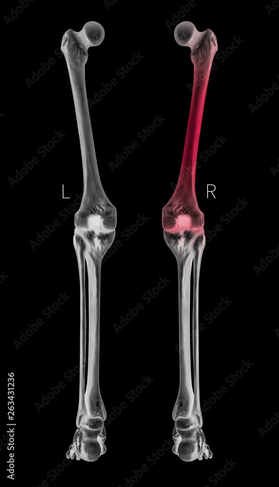 X-ray of Human Leg bone left and right- Posterior view red highlights ...